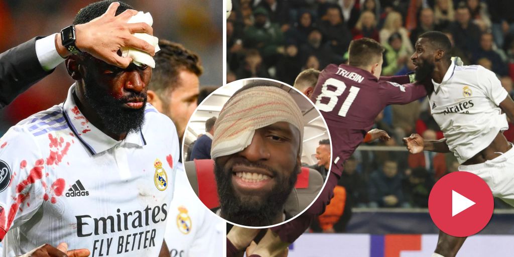 Real Madrid: Antonio Rüdiger nach Blut-Tor mit 20 Stichen genäht