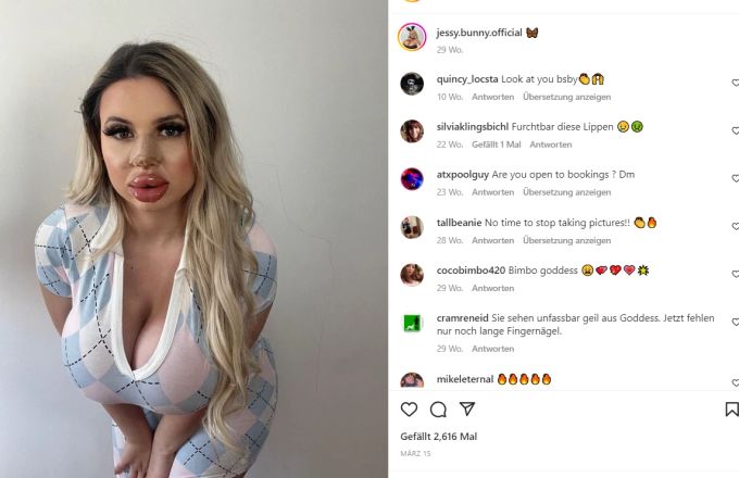 Influencerin Jessy Bunny Schockt Mit Xxxl Lippen Nauch 5239
