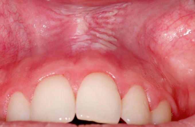 Snus-Süchtiger warnt Junge: «Man kann nicht mehr aufhören» | Nau.ch