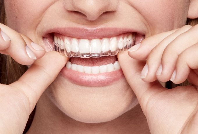 Schöne Zähne ganz ohne Draht-Zahnspange | Nau.ch