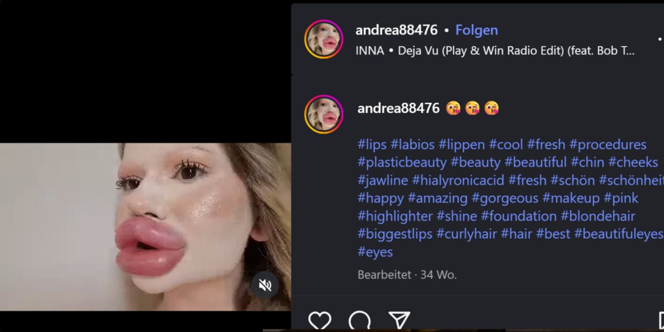 Dickste Lippen der Welt: Andrea (27) will immer weitermachen | Nau.ch