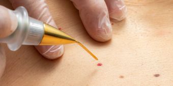 Sind rote Muttermale gefährlich? Alles was Sie dazu wissen müssen | Nau ...