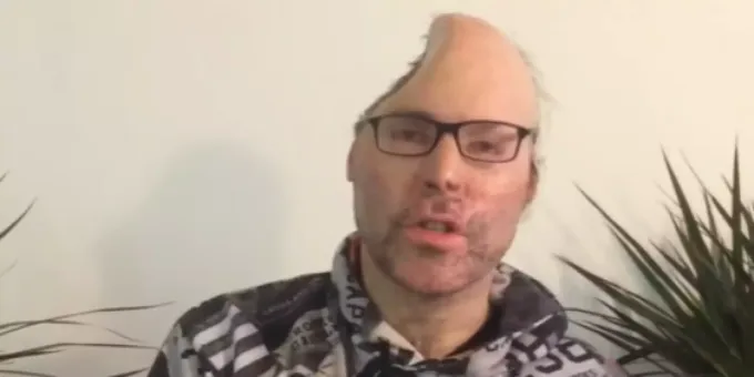 Deutscher Rapper Dr. Knarf schockiert mit halbem Schädel