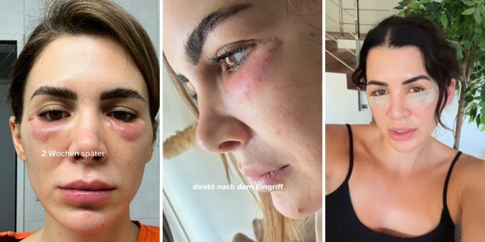 Ex-Bachelorette Andrina Santoro: Beauty-Eingriff ging schief! | Nau.ch