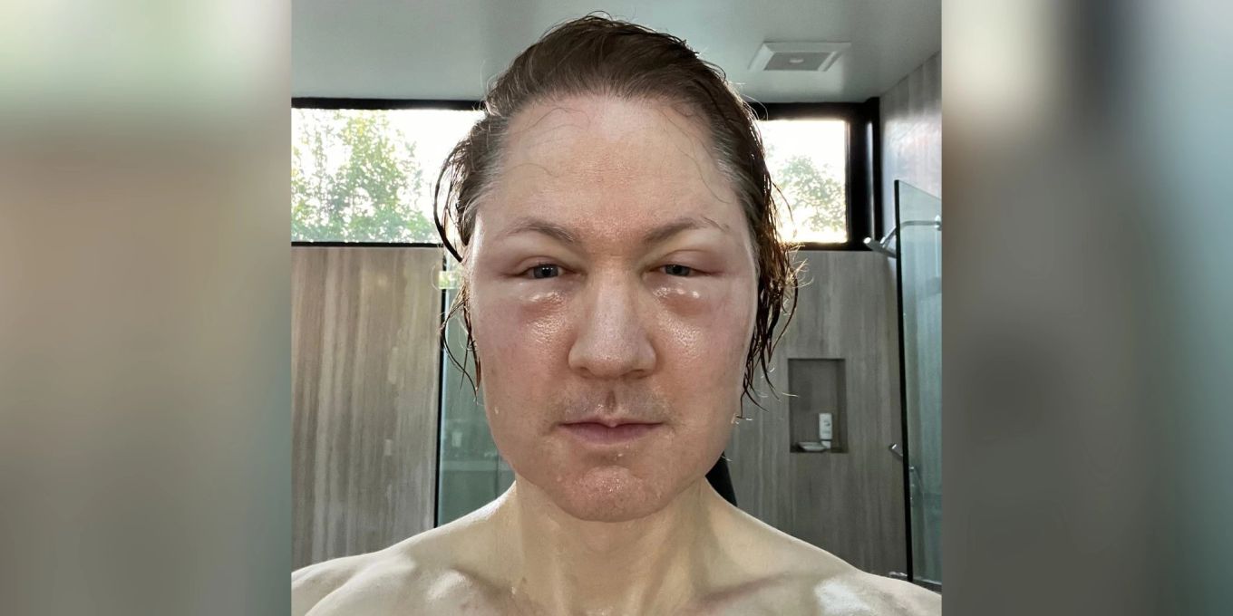 Tech-Millionär Bryan Johnson will Baby-Face – Eingriff geht schief ...