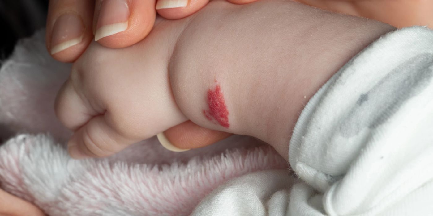 Sind rote Muttermale gefährlich? Alles was Sie dazu wissen müssen | Nau ...