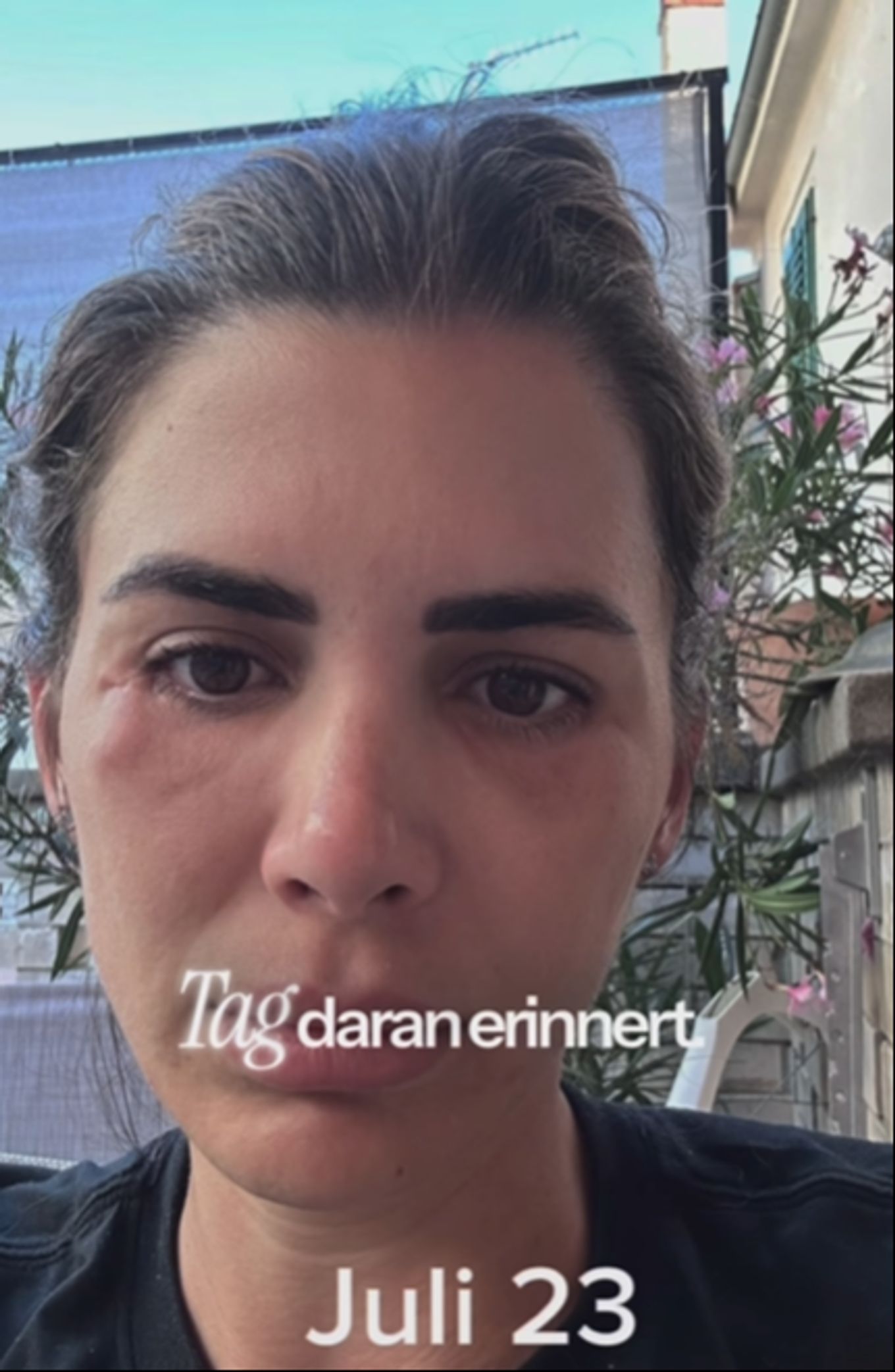 Ex-Bachelorette Andrina Santoro: Beauty-Eingriff ging schief! | Nau.ch